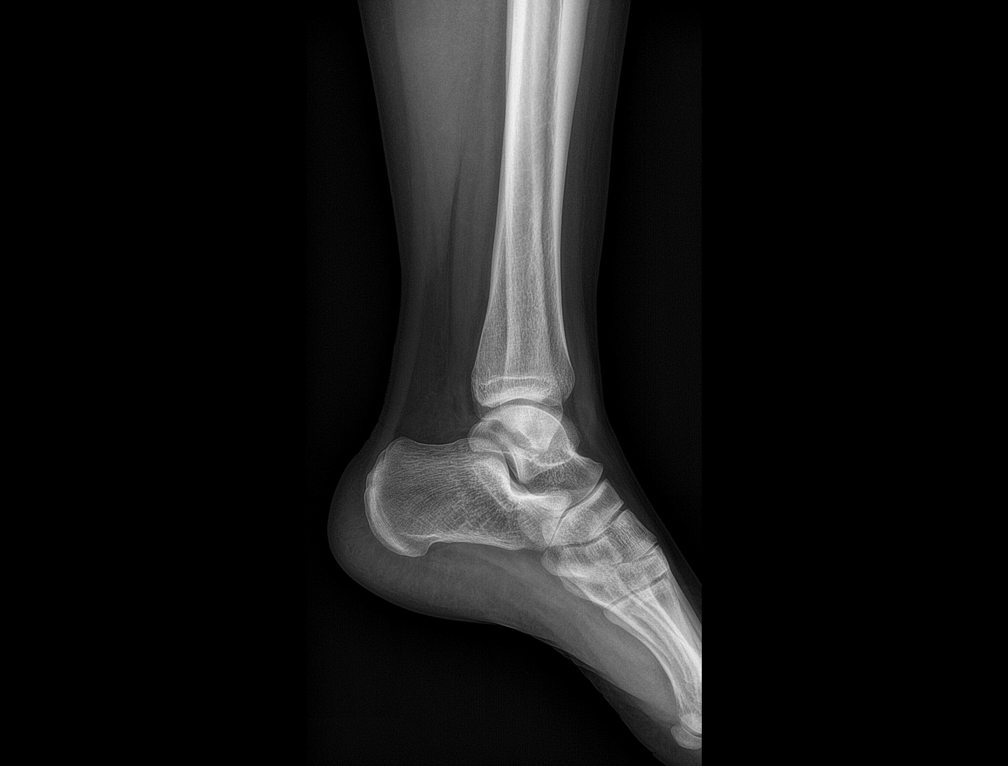 X Ray Ankle Ap