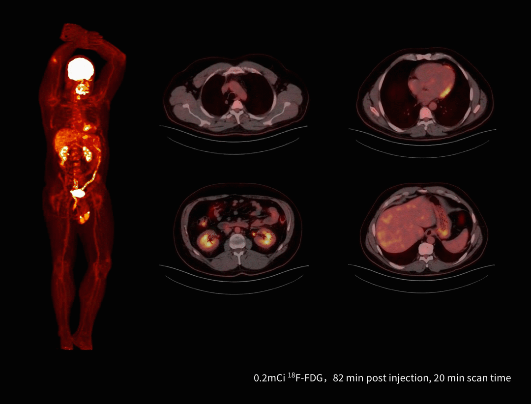 uEXPLORER®: Total-body PET/CT | United-Imaging Healthcare