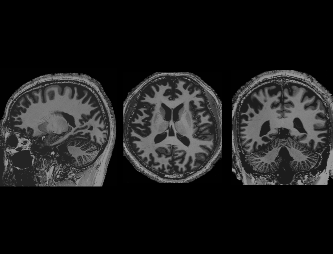 Jupiter 5.0T: The World's 1st Whole-Body UHF MRI