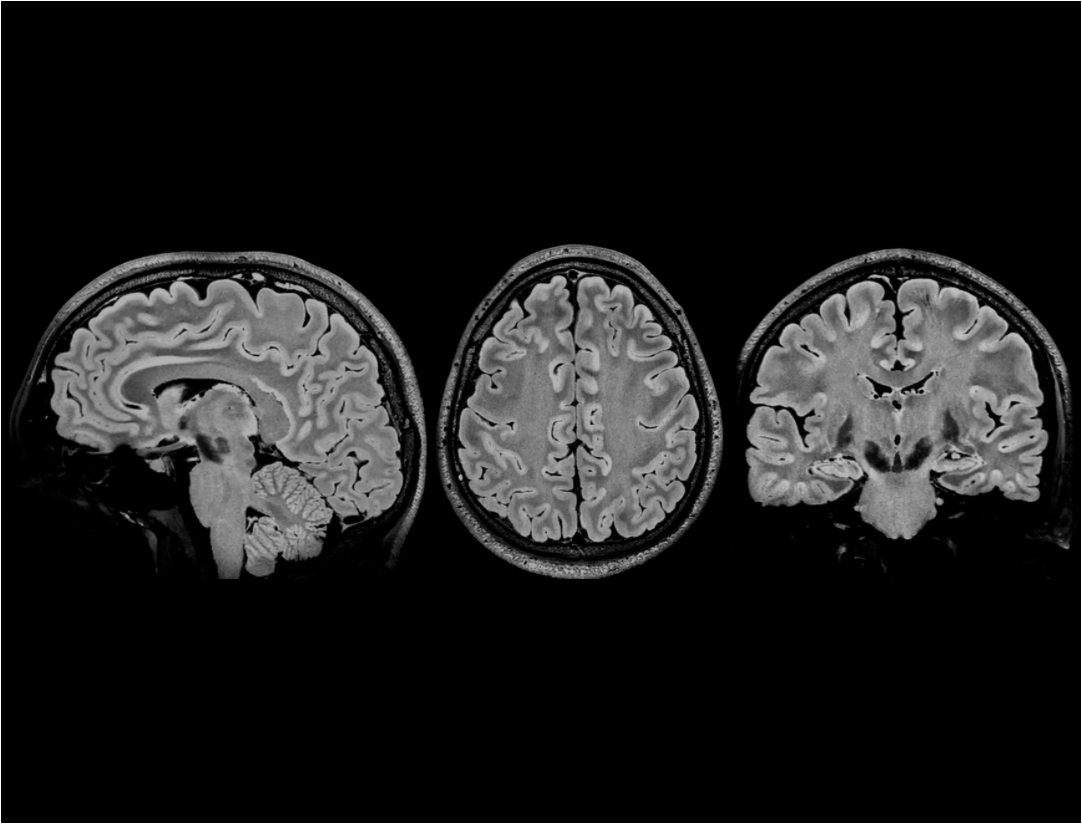 Jupiter 5.0T: The World's 1st Whole-Body UHF MRI