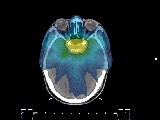 uRT-linac 306 (Intelligent Linac) | United-Imaging Healthcare