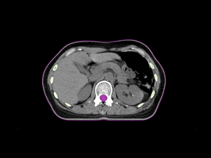 uRT-linac 506c (Integrated CT-linac) | United-Imaging