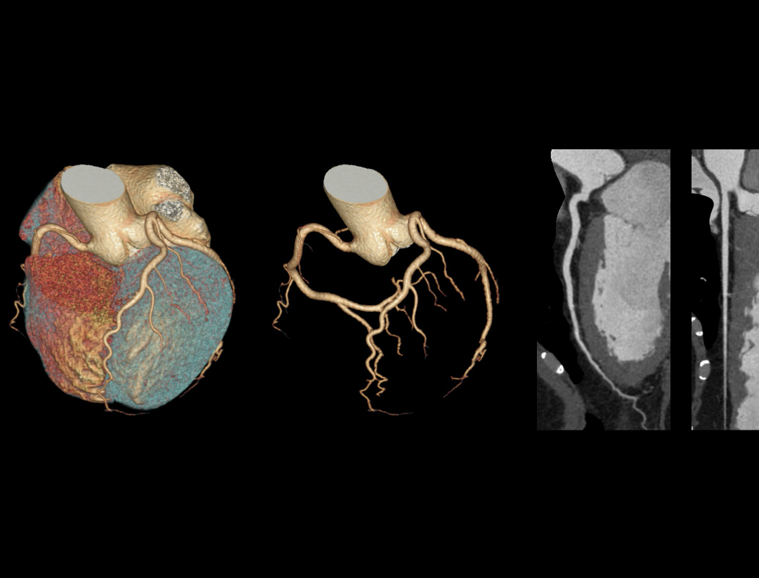 uCT 760 (Z-Detector+ 3D Iterative Denoising) | United-Imaging
