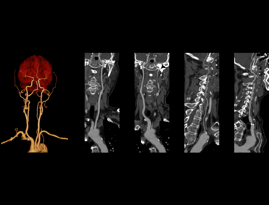 uCT 760 (Z-Detector+ 3D Iterative Denoising) | United-Imaging