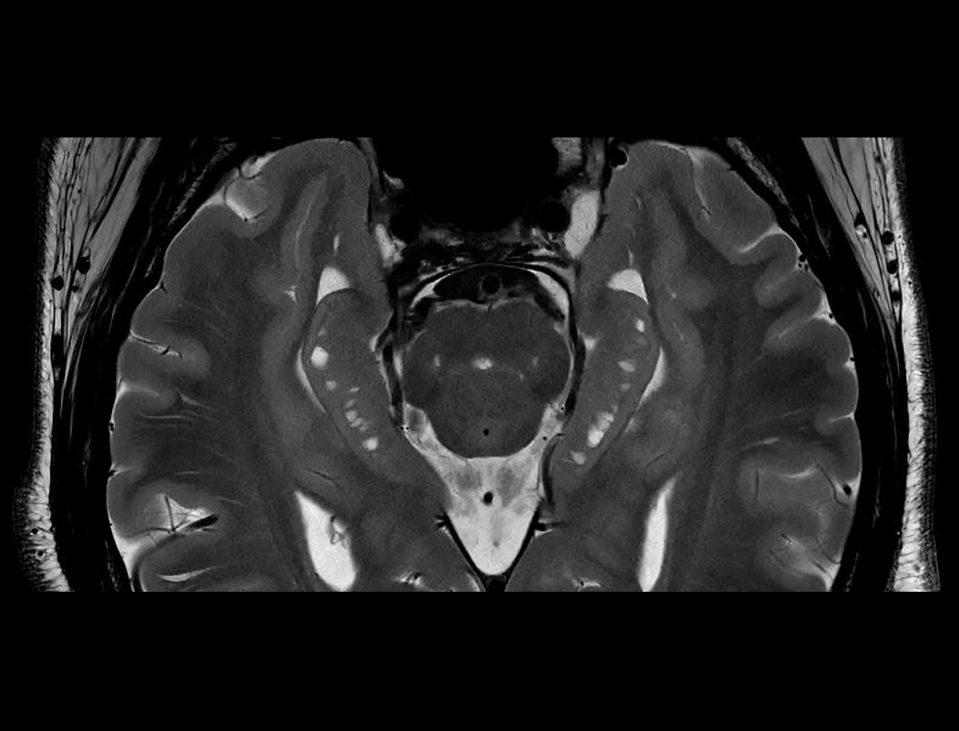uMR Omega: Ultra-wide Bore 3.0T MR | United-Imaging